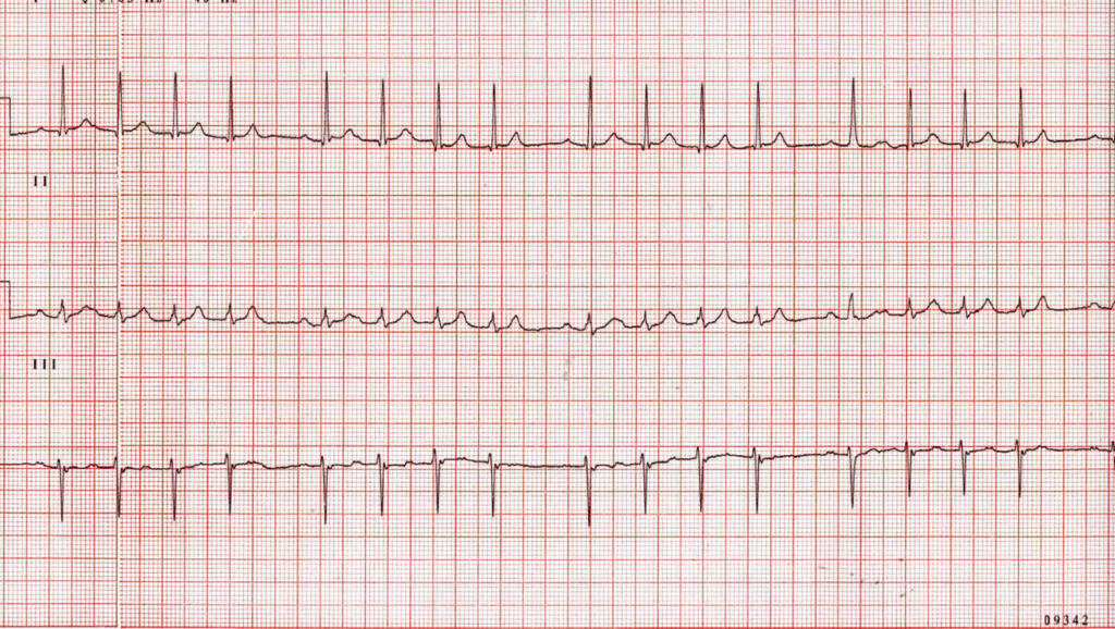 Desafío ECG 14 - ICBA Cardioblog